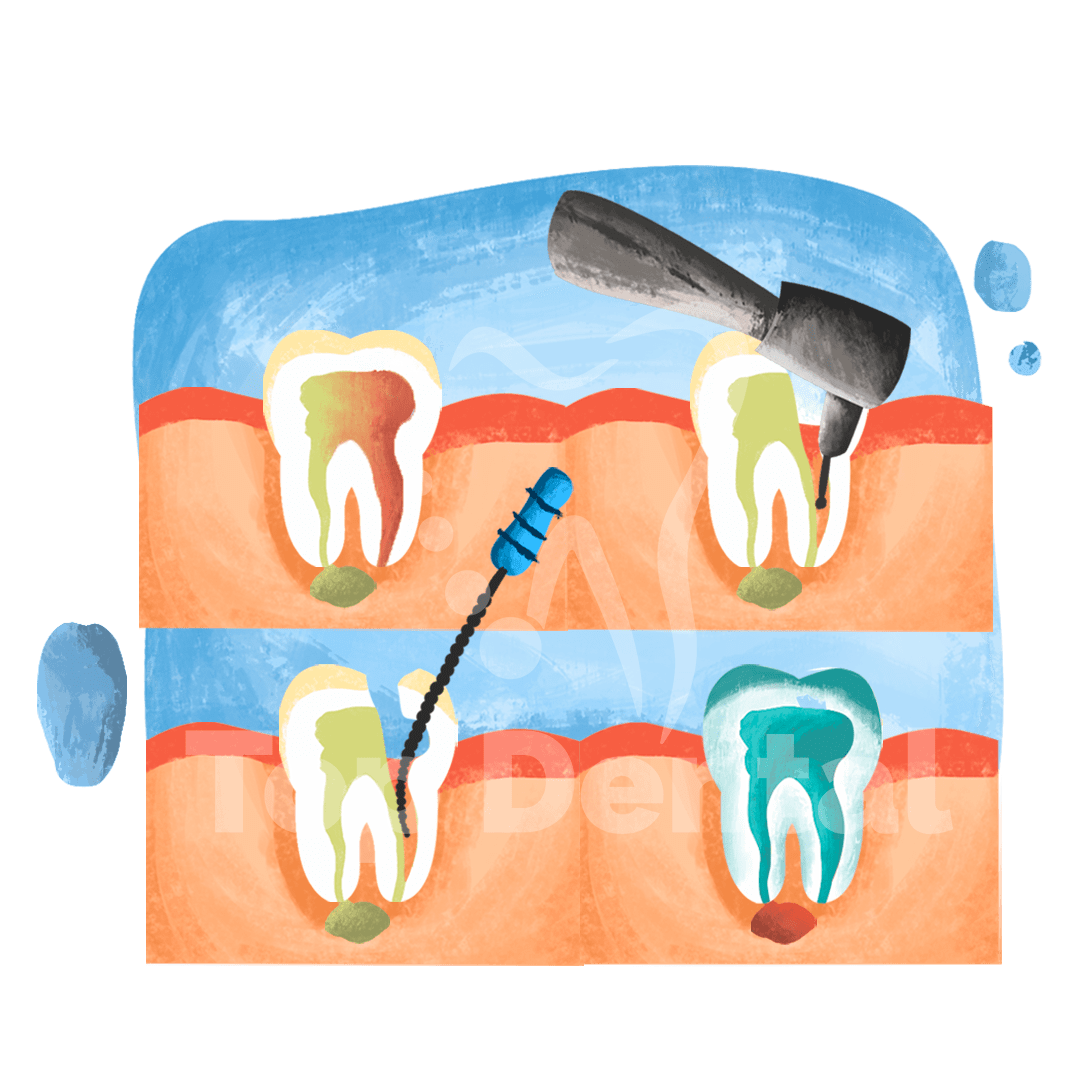 Top Dental Root Canal Top Dental Root Canal